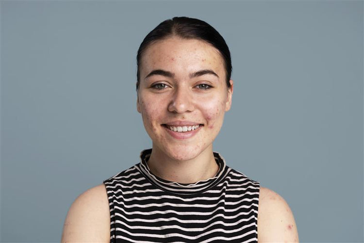 Different Types of Acne Scars and Their Treatments